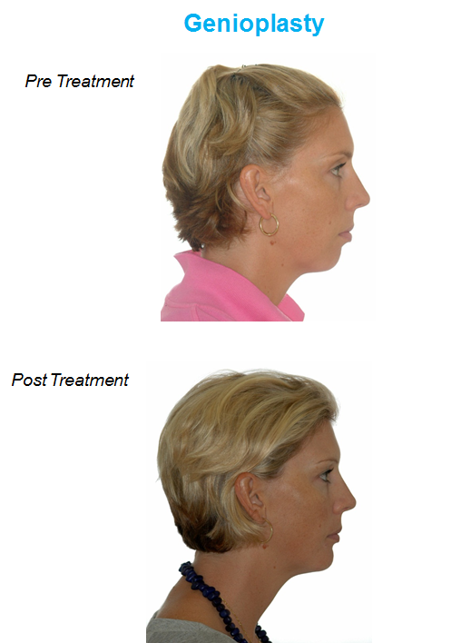 Gallery Before and After - Mehta Orthodontics